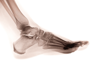 Heel Spur Steroid Injections for Pain Relief | New York Neurology ...